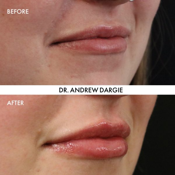 Neuromodulators & Injectables - North Okanagan Skin & Laser