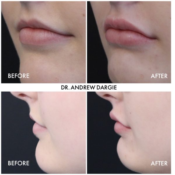 Neuromodulators & Injectables - North Okanagan Skin & Laser