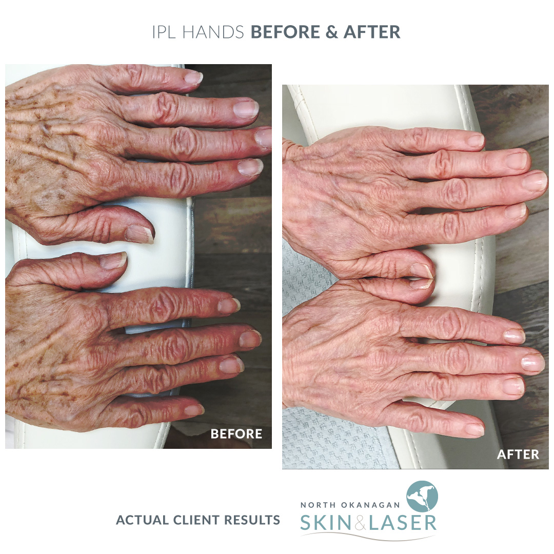 IPL Photorejuvenation - North Okanagan Skin & Laser